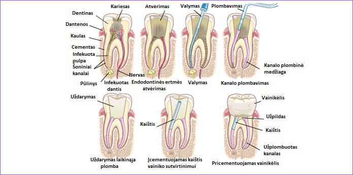 Endodontija - Gikeda